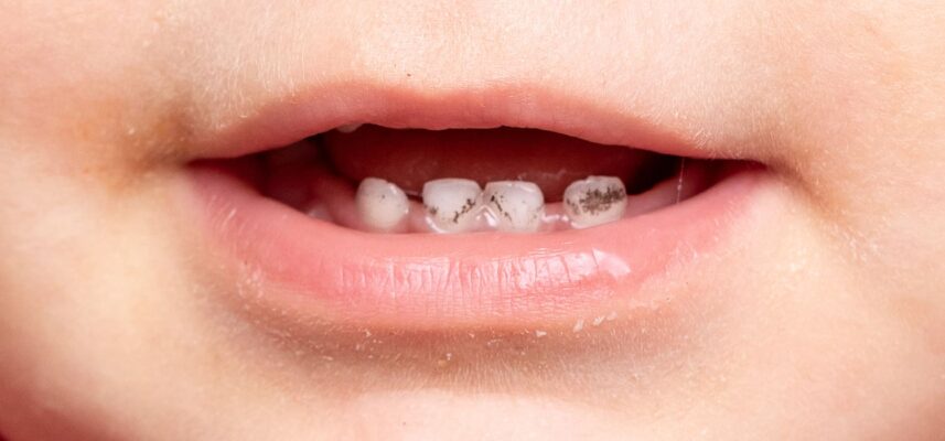 Tooth Decay in Children: Causes, Symptoms, and Prevention | Watthe Health